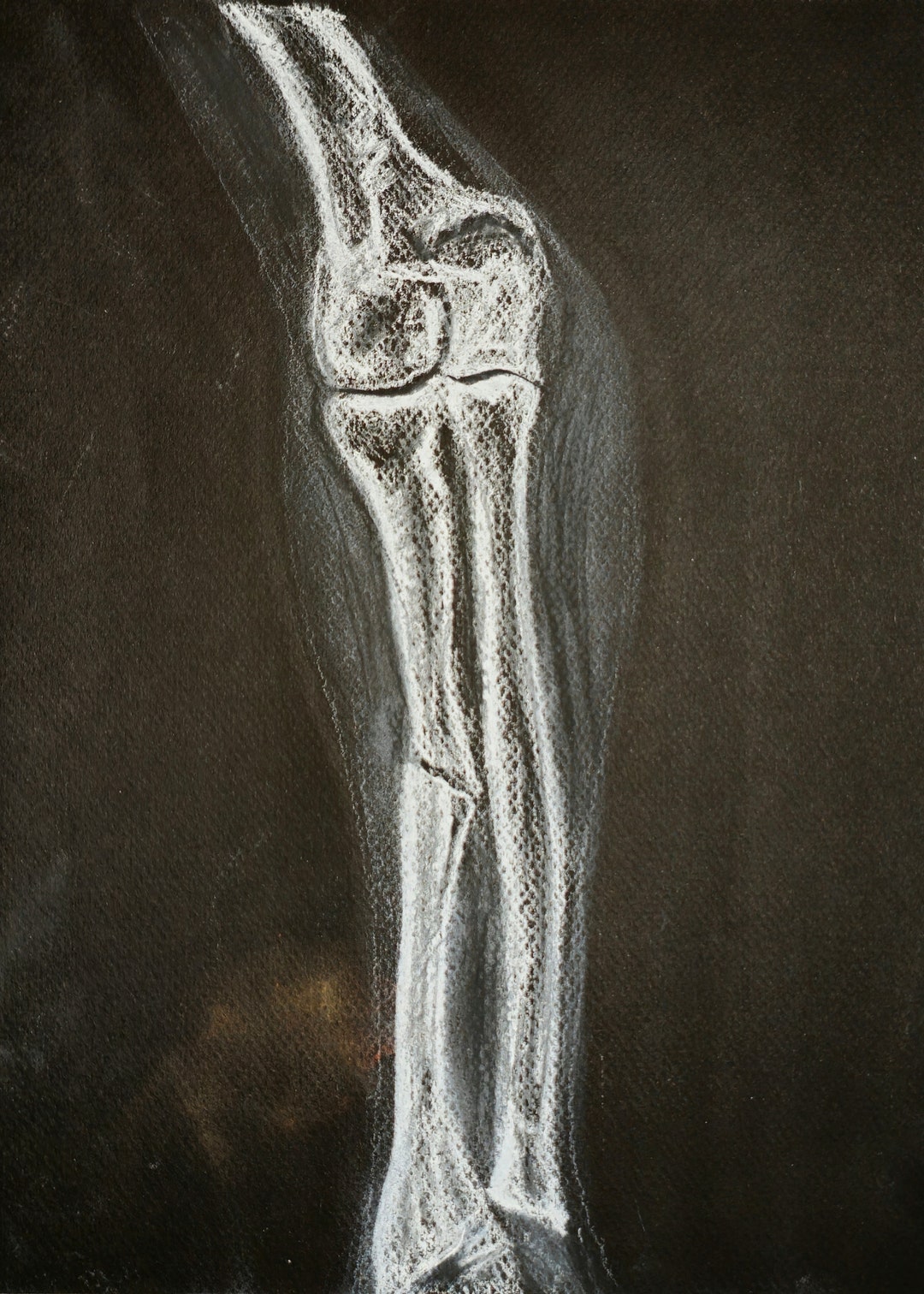 Broken Arm Anatomy X-ray Art Print 11 X 14 Inches, Bones, Horror ...