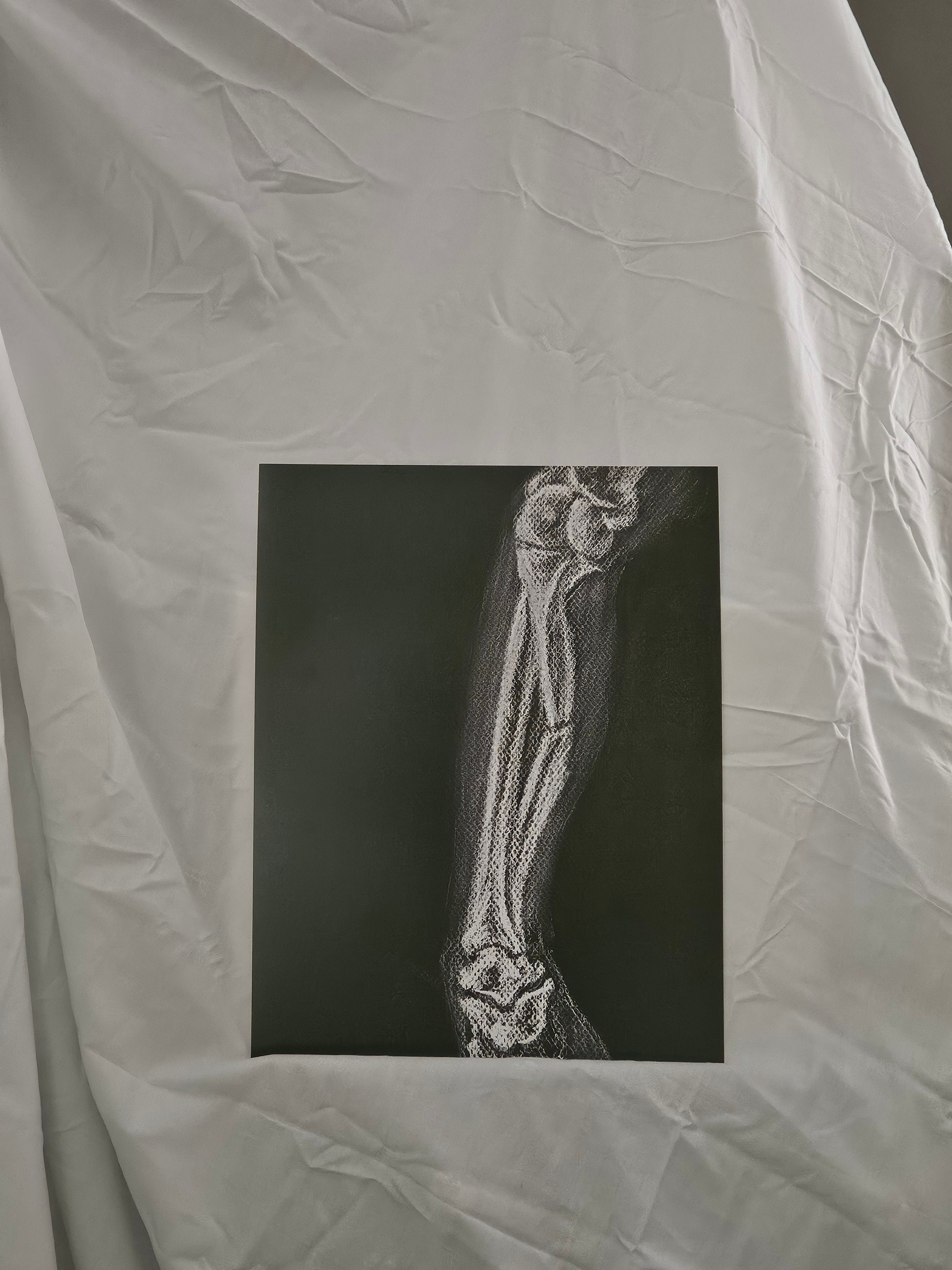 Broken Leg Anatomy X-ray Art Print 11 X 14 Inches, Bones, Horror ...