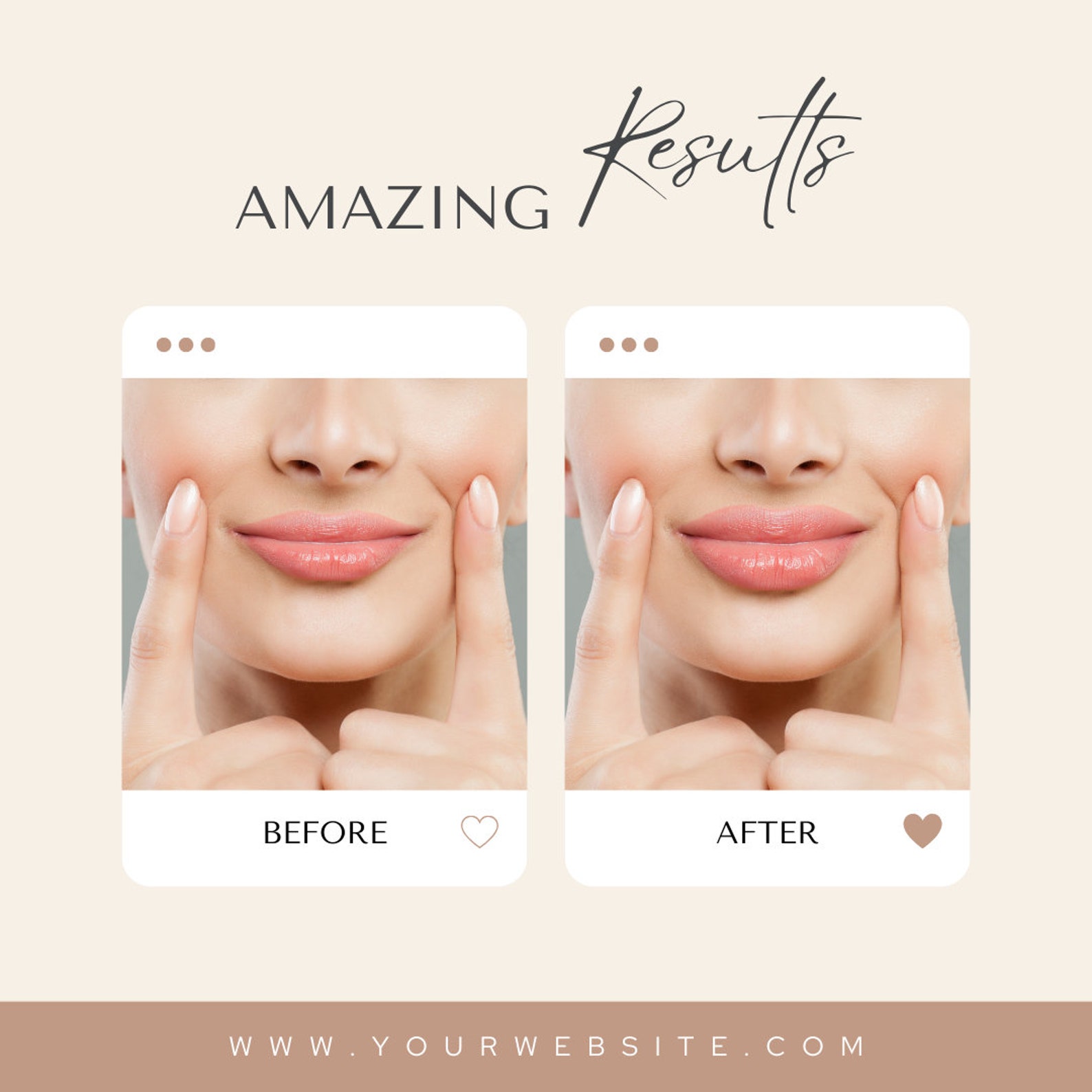 50 Botox and Filler Instagram Posts, Nurse Injector Instagram Templates ...