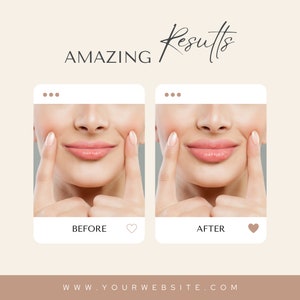 50 Botox and Filler Instagram Posts, Nurse Injector Instagram Templates ...
