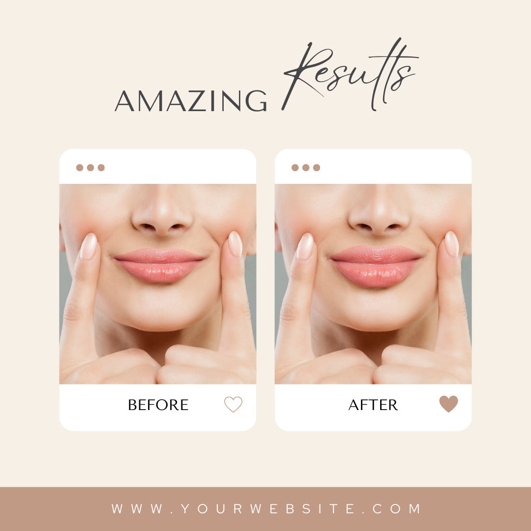 50 Botox and Filler Instagram Posts, Nurse Injector Instagram Templates ...