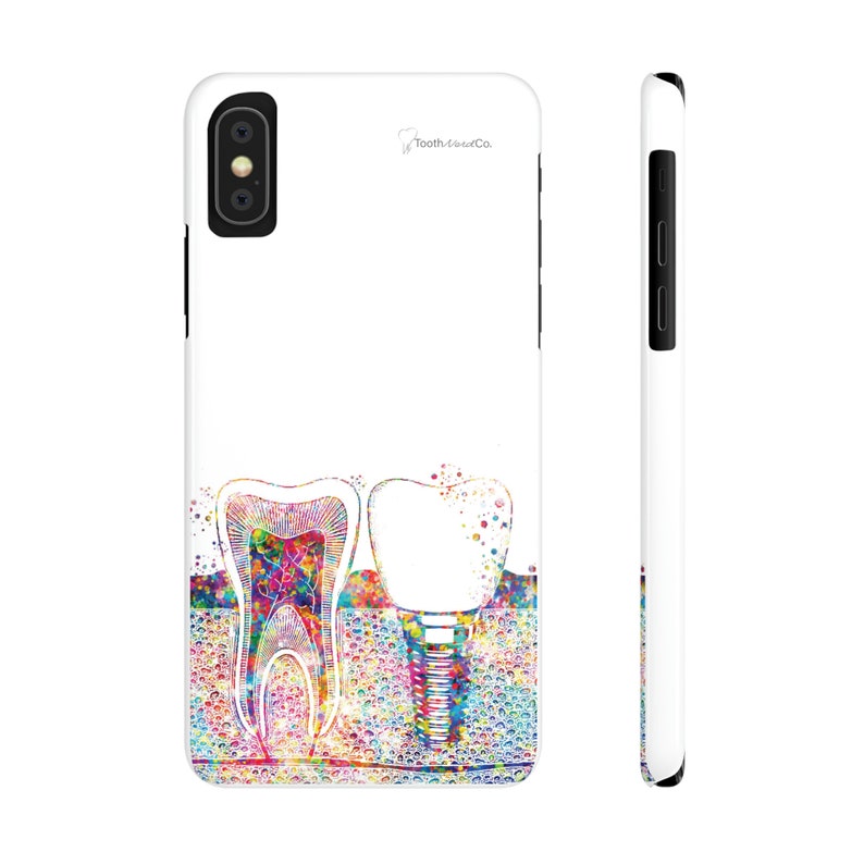 Dental Art Tooth Anatomy With Molar and Implant Slim iPhone Cases for ...