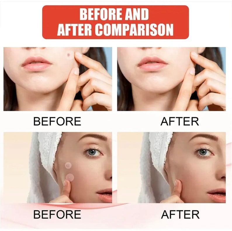 Acne Patch Tag Hydrocolloid Pimple Spot Acne Patch Plaster 144 in A ...