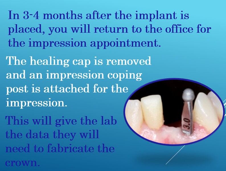 Patient Education Power Point-implants - Etsy