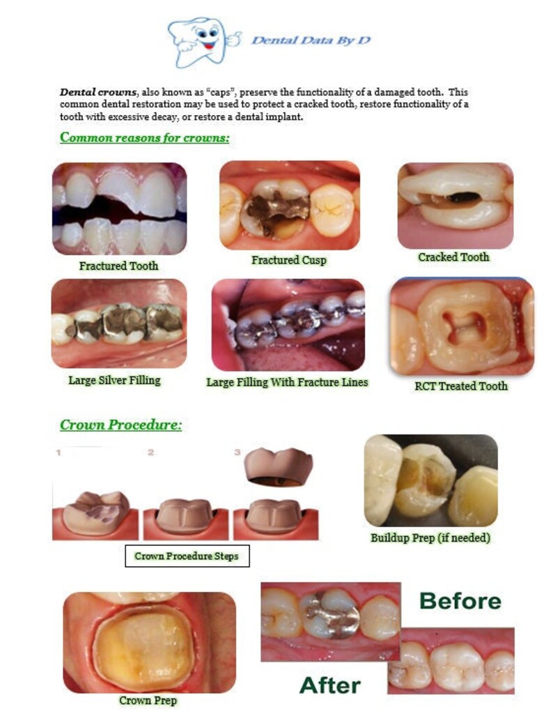Dental Patient Education-crown Procedure Handout - Etsy