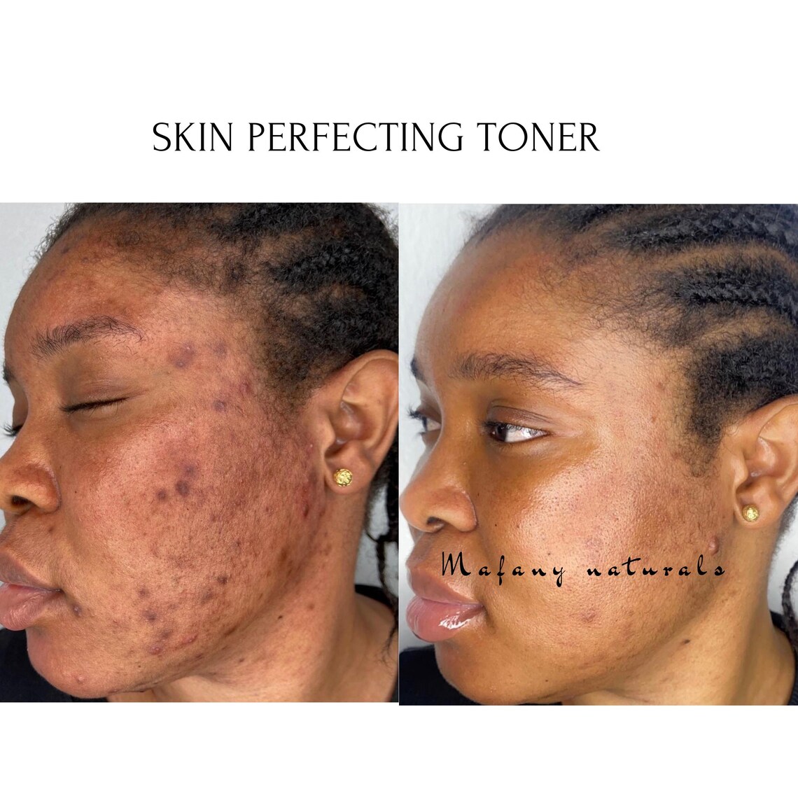 Turmeric Toner, Very Effective, Skin Perfecting Toner 4oz - Etsy