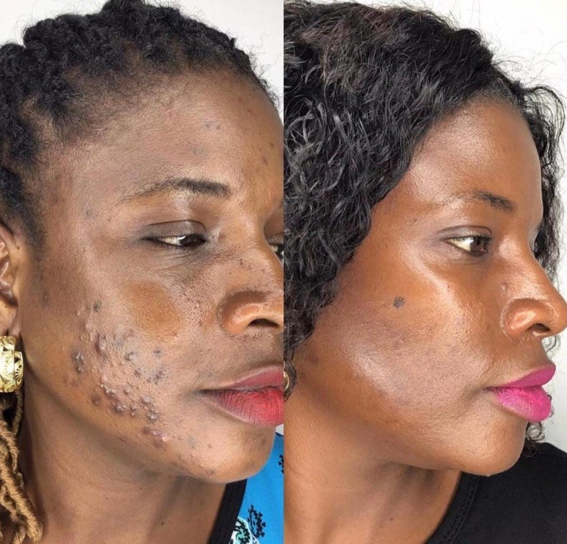 Turmeric Face Cream, Dark Spot Remover, Even, Glowing, Even Skin Tone ...