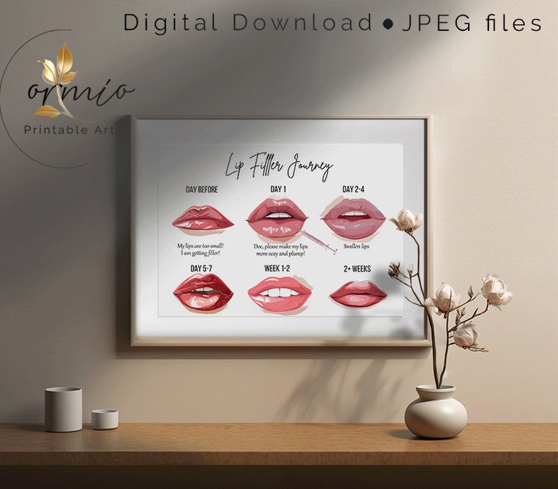 Lip Filler Journey Poster: Aesthetics Clinic Decor (printable Art) - Etsy