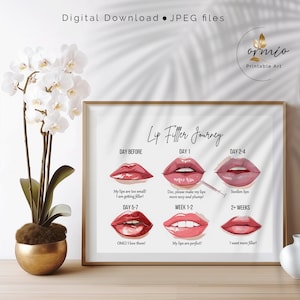 Lip Filler Journey Poster: Aesthetics Clinic Decor (printable Art) - Etsy