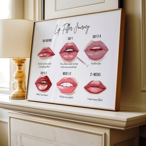 Lip Filler Journey Poster: Aesthetics Clinic Decor (printable Art) - Etsy