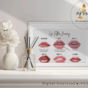 Lip Filler Journey Poster: Aesthetics Clinic Decor (printable Art) - Etsy