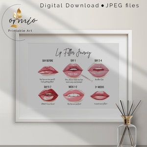 Lip Filler Journey Poster: Aesthetics Clinic Decor (printable Art) - Etsy