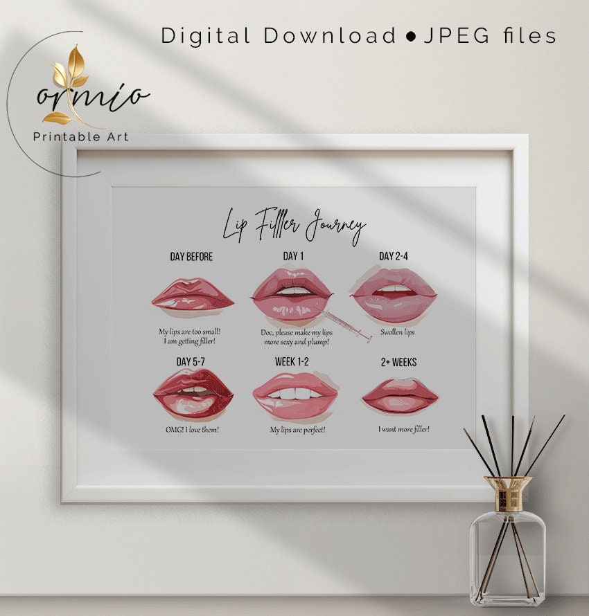 Lip Filler Journey Poster: Aesthetics Clinic Decor (printable Art) - Etsy