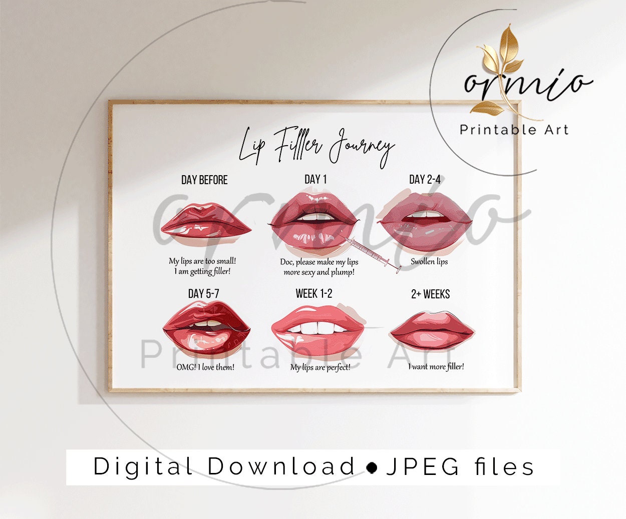 Lip Filler Journey Poster: Aesthetics Clinic Decor (printable Art) - Etsy