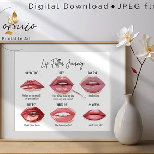 Lip Filler Journey Poster: Aesthetics Clinic Decor (printable Art) - Etsy