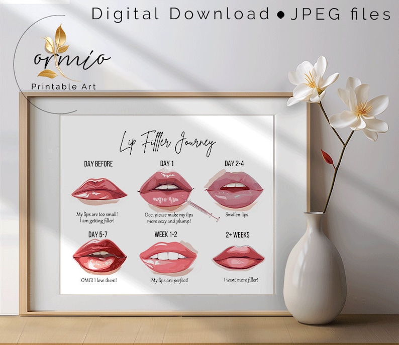 Lip Filler Journey Poster: Aesthetics Clinic Decor (printable Art) - Etsy