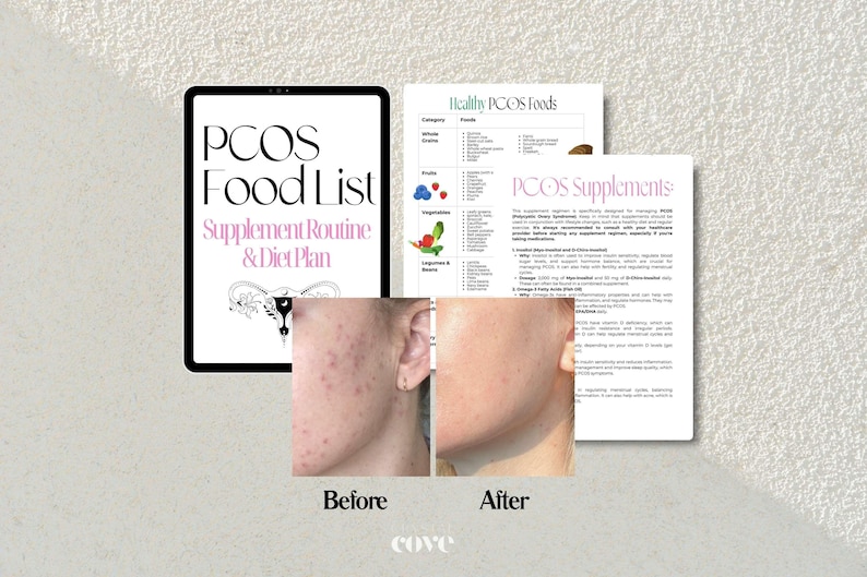 PCOS Food List & Diet Plan for Managing PCOS Weight Loss and Acne | Low ...
