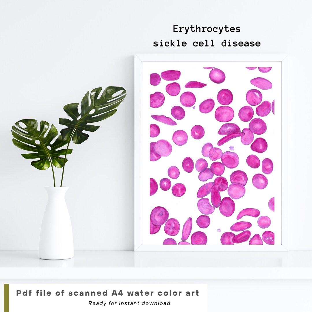 Sickle Cell Disease, Erythrocytes, Blood Cells, Water Color Art ...