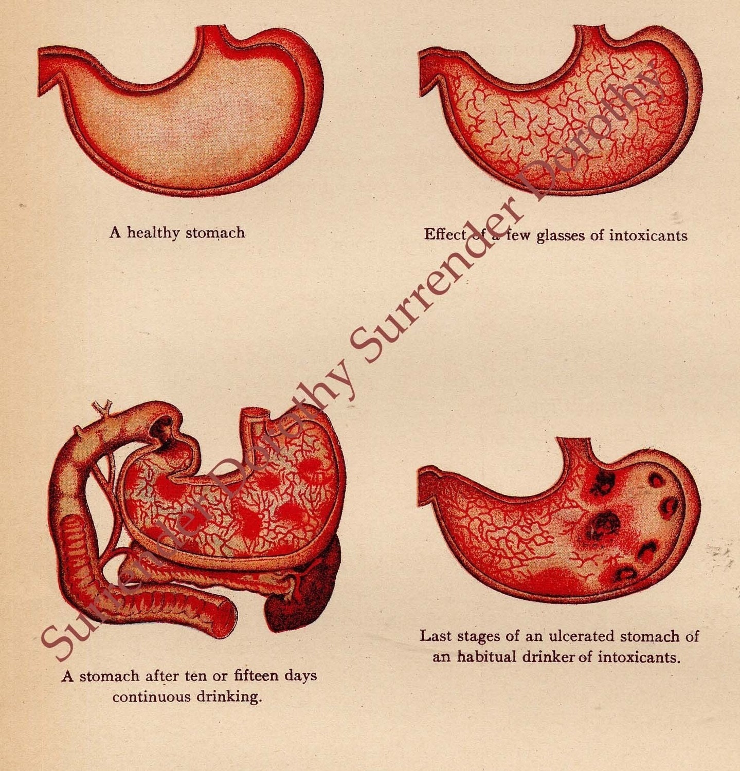 Effects of Alcohol on the Stomach 1908 Antique Human Anatomy - Etsy