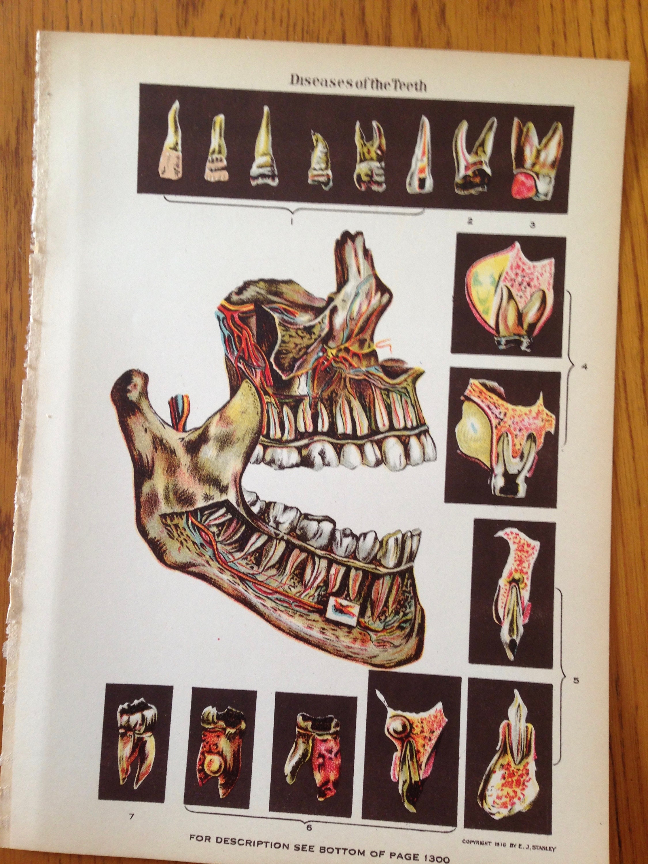 Human Anatomy Tooth Disease Creepy Tooth Fairy 1908 Medical Dental ...