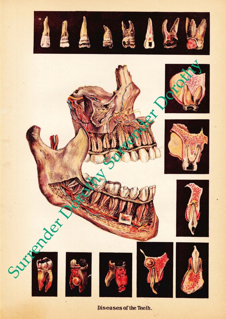 Human Anatomy Tooth Disease Creepy Tooth Fairy 1908 Medical | Etsy