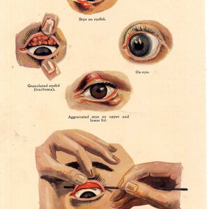 Eye Disease Human Anatomy Lithograph Medical Chart Having A Bad Eye Day ...