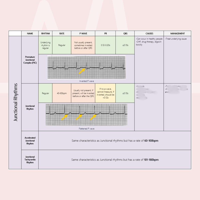EKG Study Guide for Nursing Student Nursing Note for New Grad Nurse EKG ...
