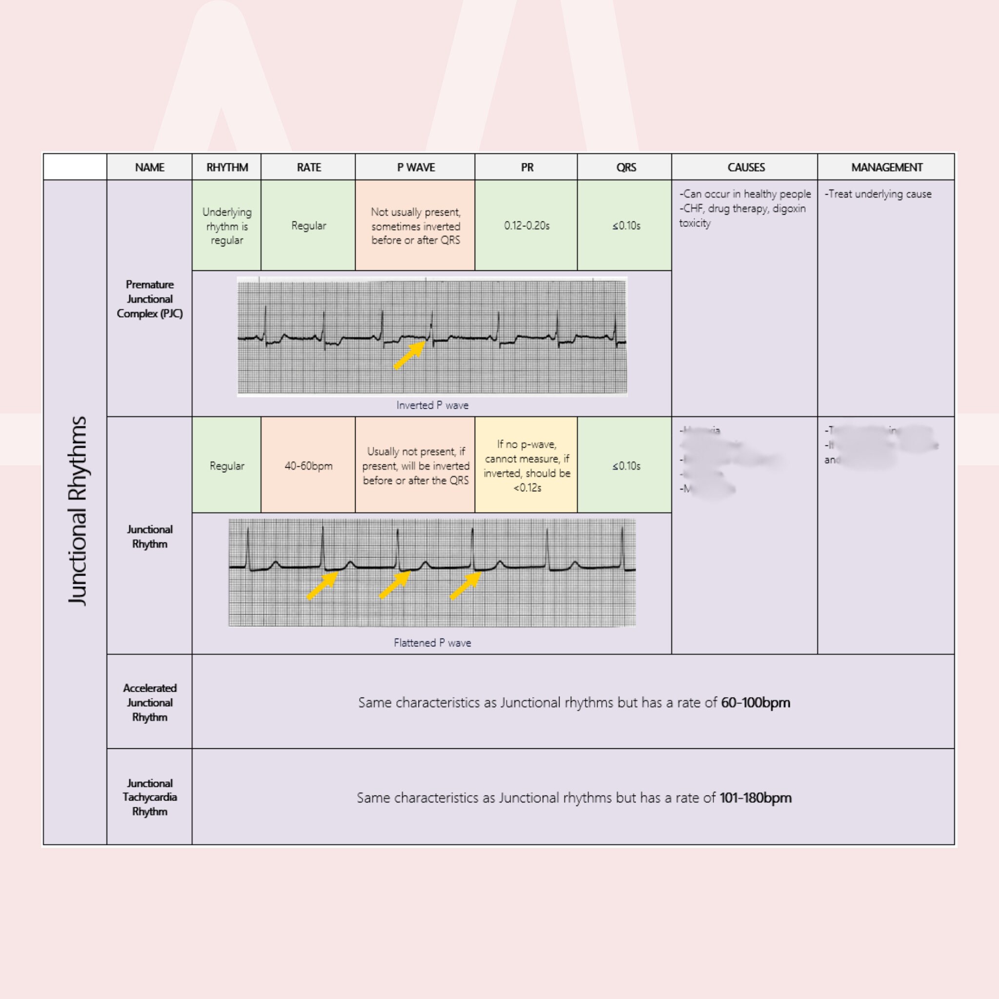 EKG Study Guide for Nursing Student Nursing Note for New Grad Nurse EKG ...