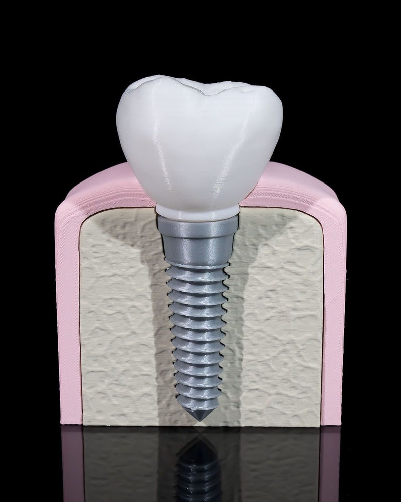 Realistic Dental Implant | 3D Printed Teeth Replica - Etsy