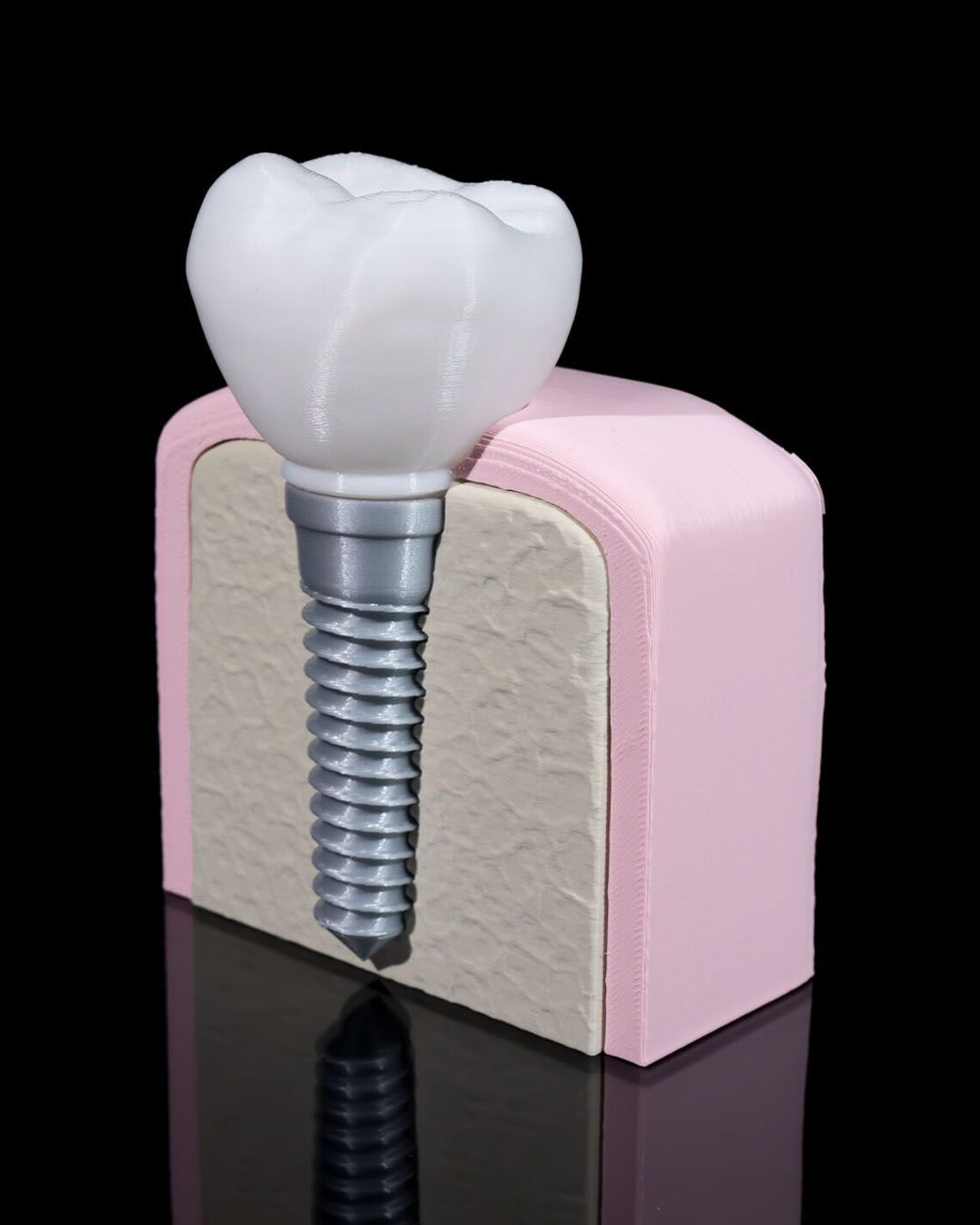 Realistic Dental Implant | 3D Printed Teeth Replica - Etsy