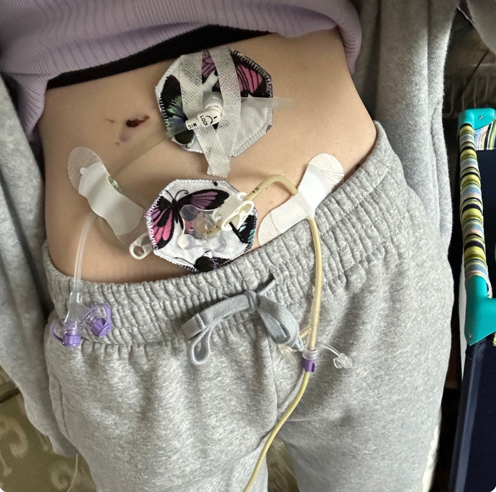 LARGE 3.5” Gtube Pads, Tubie Pads, G Tube Button Feeding Tube Covers ...