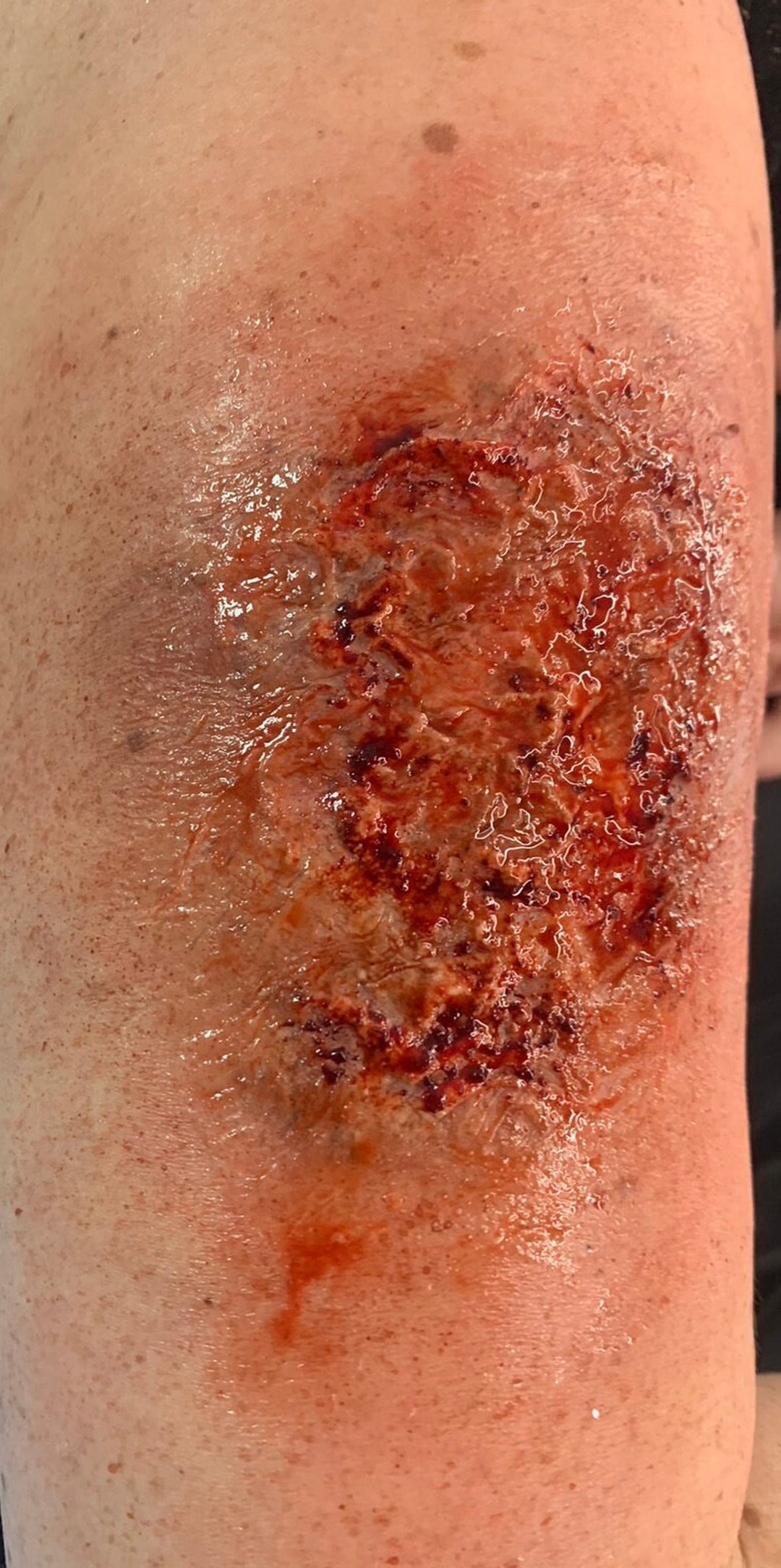 Prosthetic Burns - Etsy