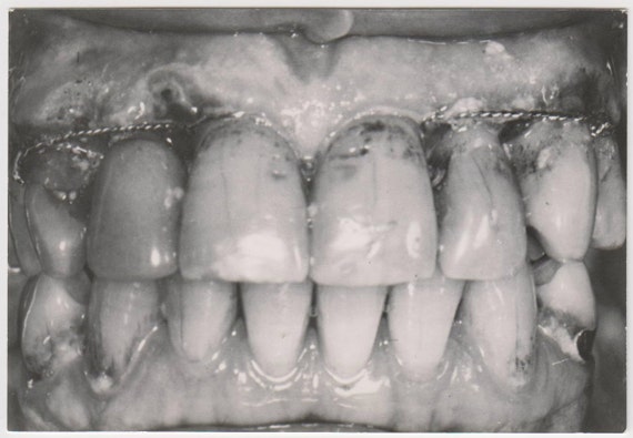 Items similar to Found Photograph Wired Jaw Dirty Teeth Photo on Etsy