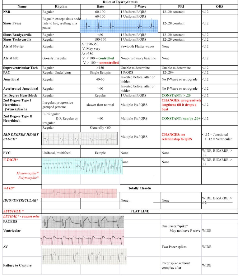 ECG Dysrhythmia Rules Cheat Sheet & Study Guide - Etsy