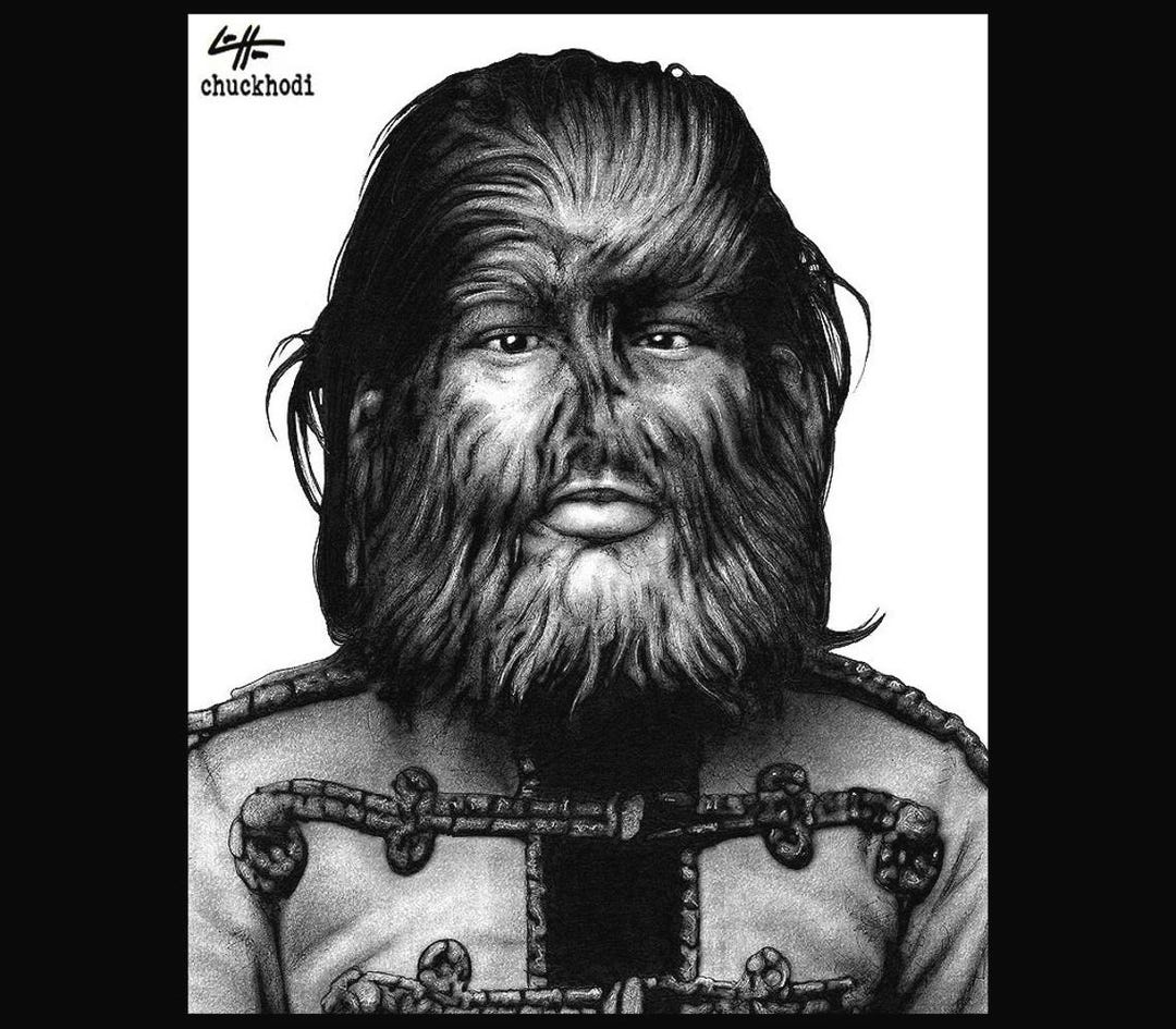 Jojo the Dog Faced Boy - Fedor Jeftichew Werewolf Syndrome Sideshow ...
