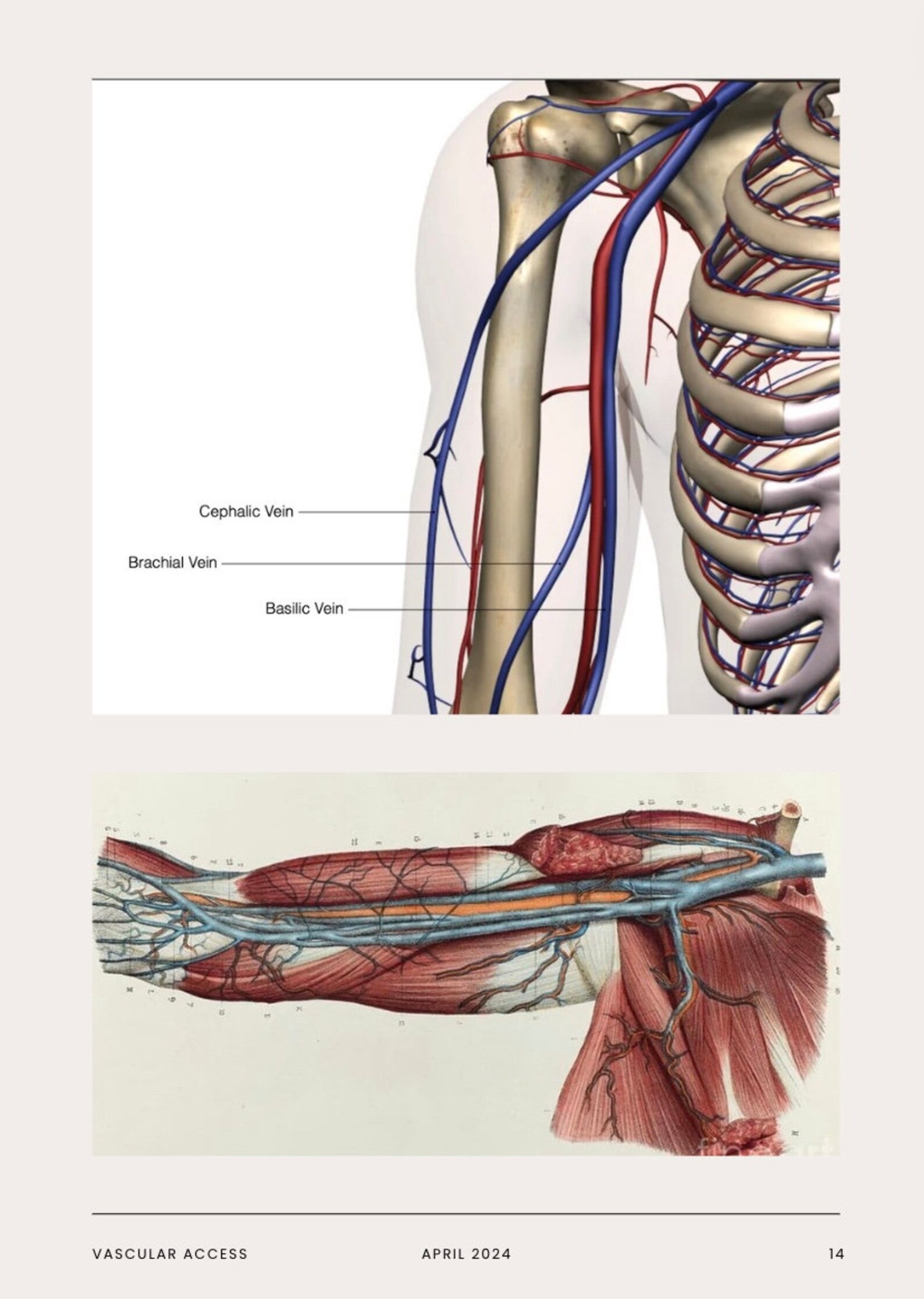 Midline Catheters: A Comprehensive Guide for Healthcare Professionals ...