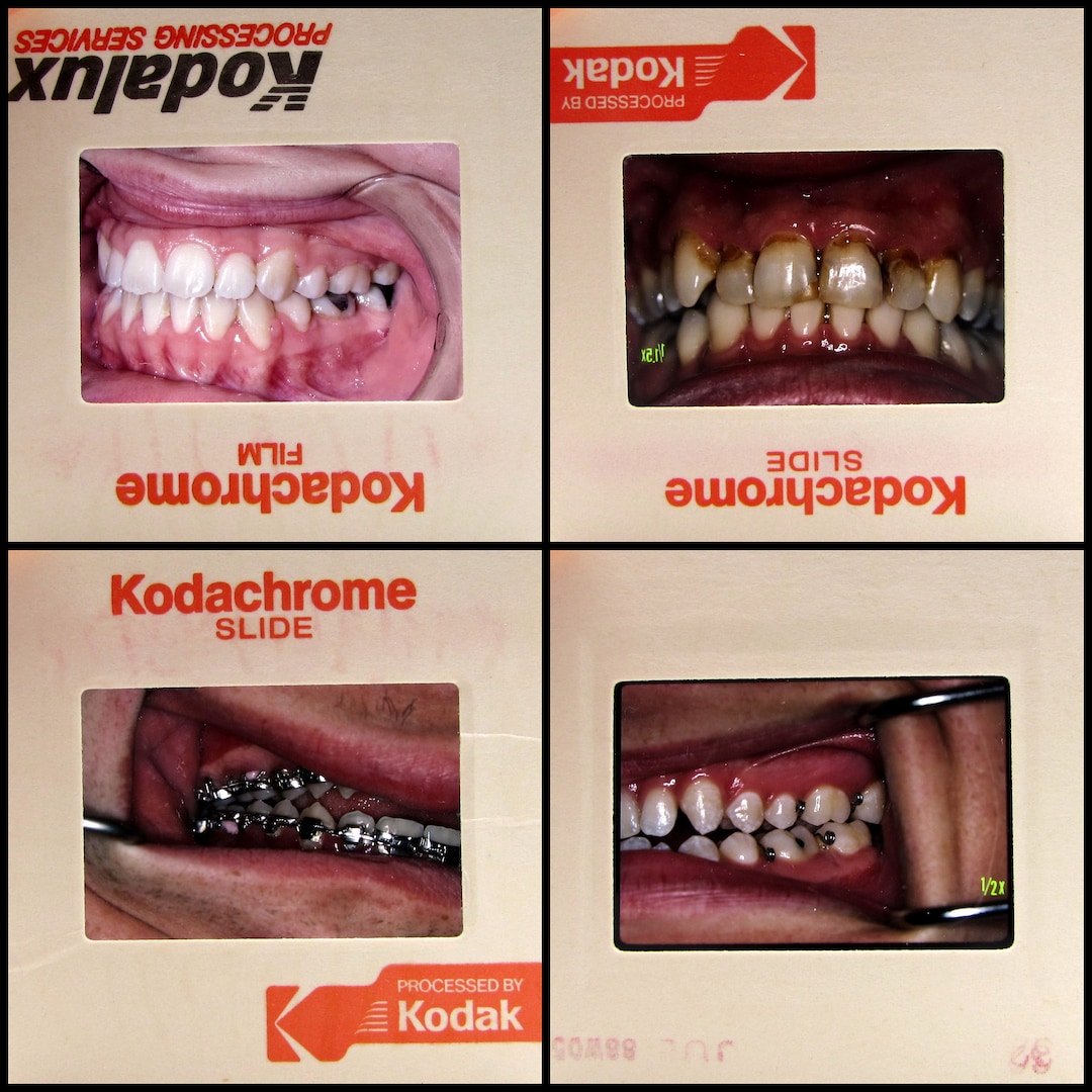 25 Teeth Slides - Vintage 35mm Photo Slides - Dental - Medical Oddities ...