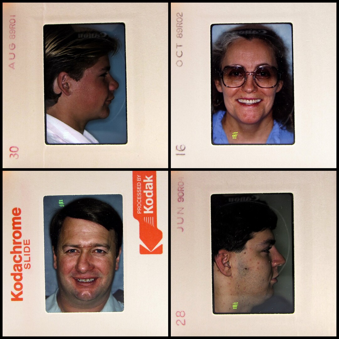 25 Faces Slides - Vintage 35mm Photo Slides - Dental - Medical Oddities ...