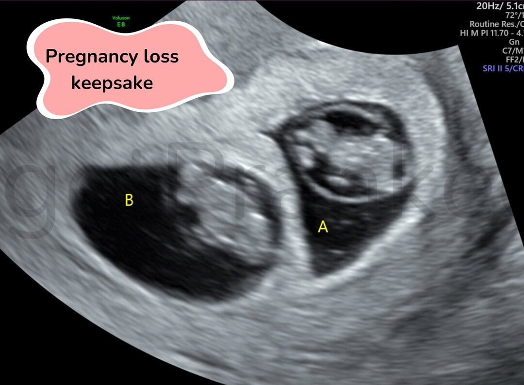 Twin Custom Pregnancy Prank Ultrasound Digital Image Fake Sonogram ...