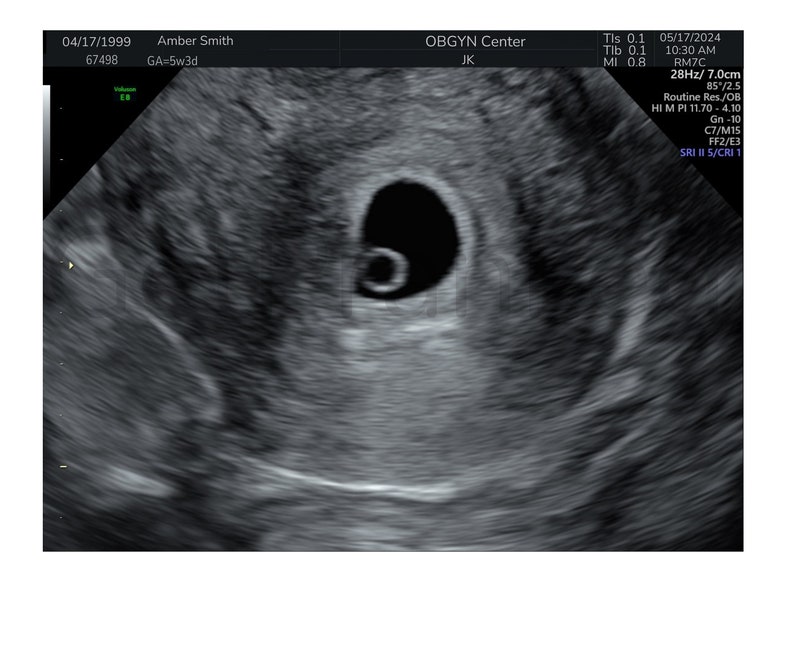 Twin Custom Pregnancy Loss Ultrasound Digital Miscarriage Sonogram ...