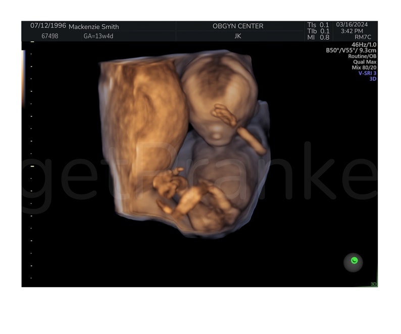 Twin Custom Pregnancy Loss Ultrasound Digital Miscarriage Sonogram ...