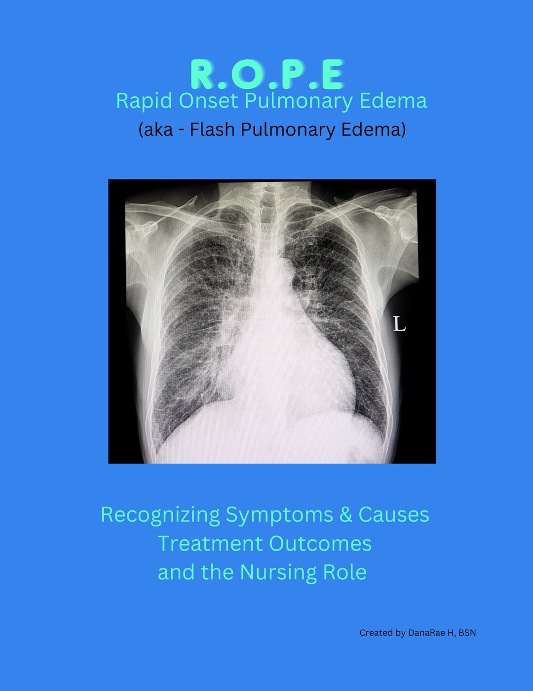 R.O.P.E Aka Acute / Flash Pulmonary Edema - Causes and Treatment and ...