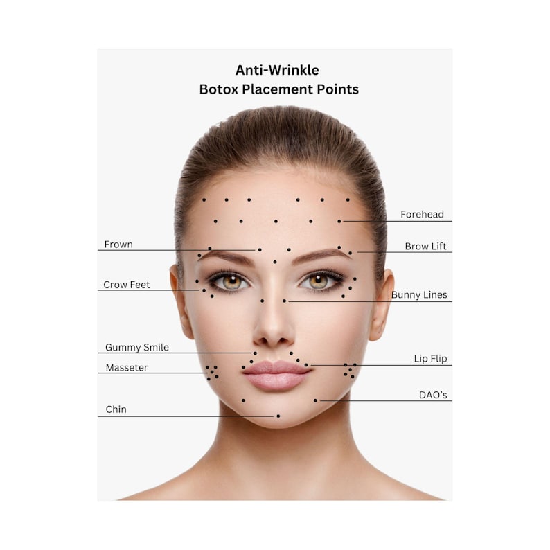 Customized With Logo Anti-wrinkle Botox Placement Points Poster, Medspa ...