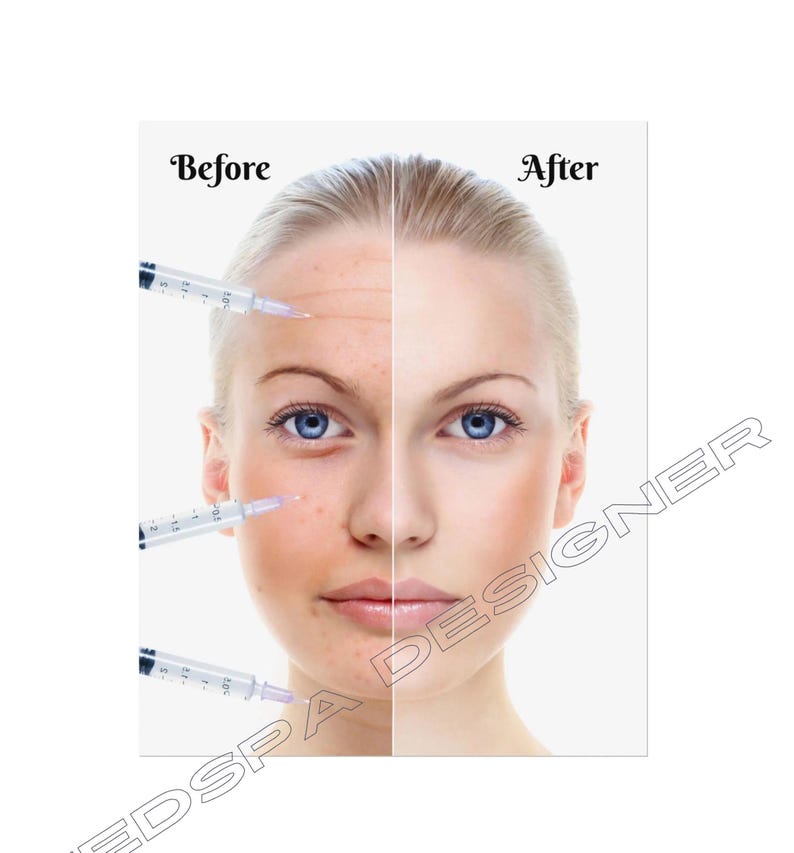 Botox Treatment Before and After Rolled Poster, Med Spa Poster ...