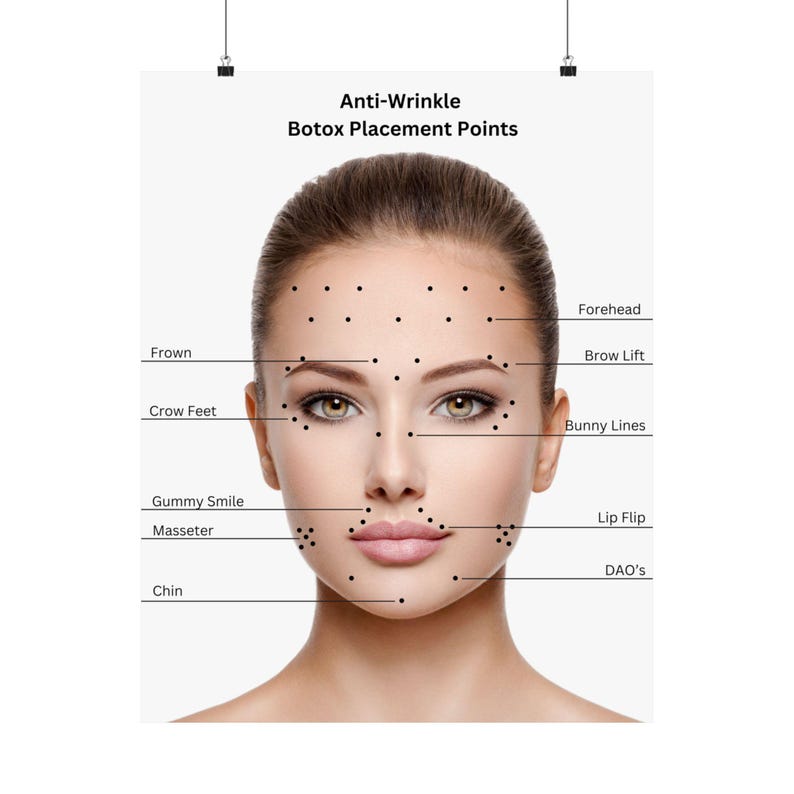 Customized With Logo Anti-wrinkle Botox Placement Points Poster, Medspa ...
