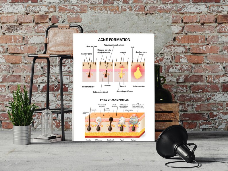 Acne Formation Digital Download, Aesthetic Clinic Dermatologist Beauty ...