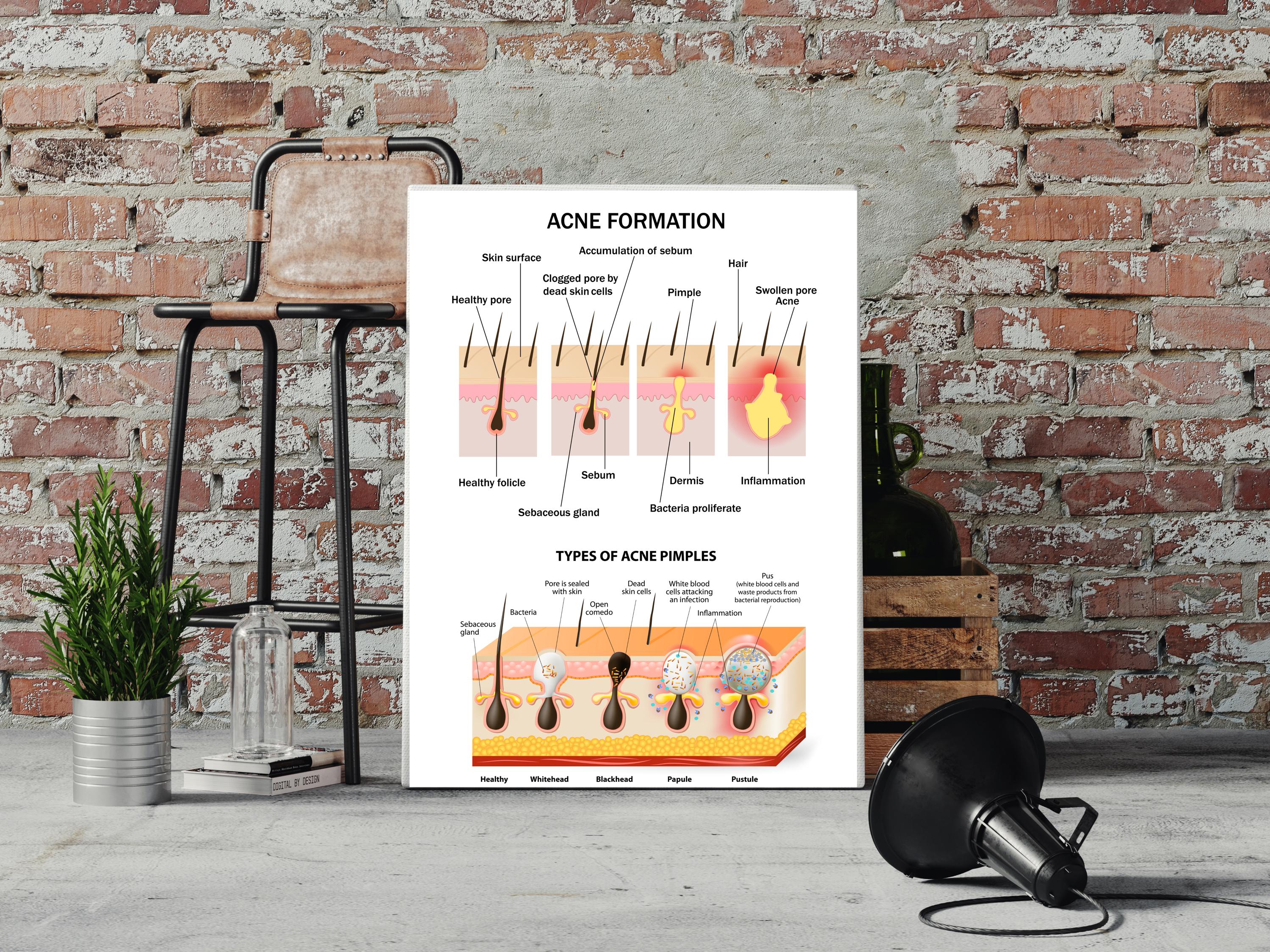 Acne Formation Digital Download, Aesthetic Clinic Dermatologist Beauty ...