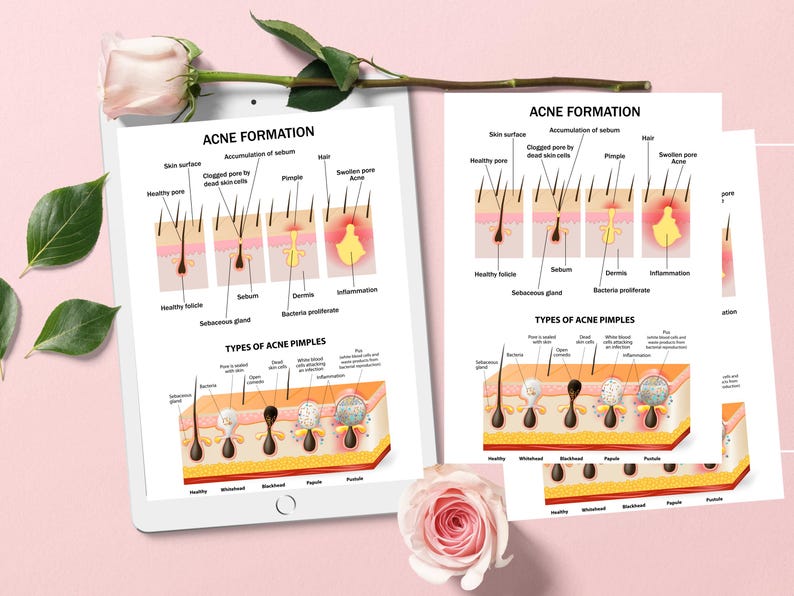 Acne Formation Digital Download, Aesthetic Clinic Dermatologist Beauty ...