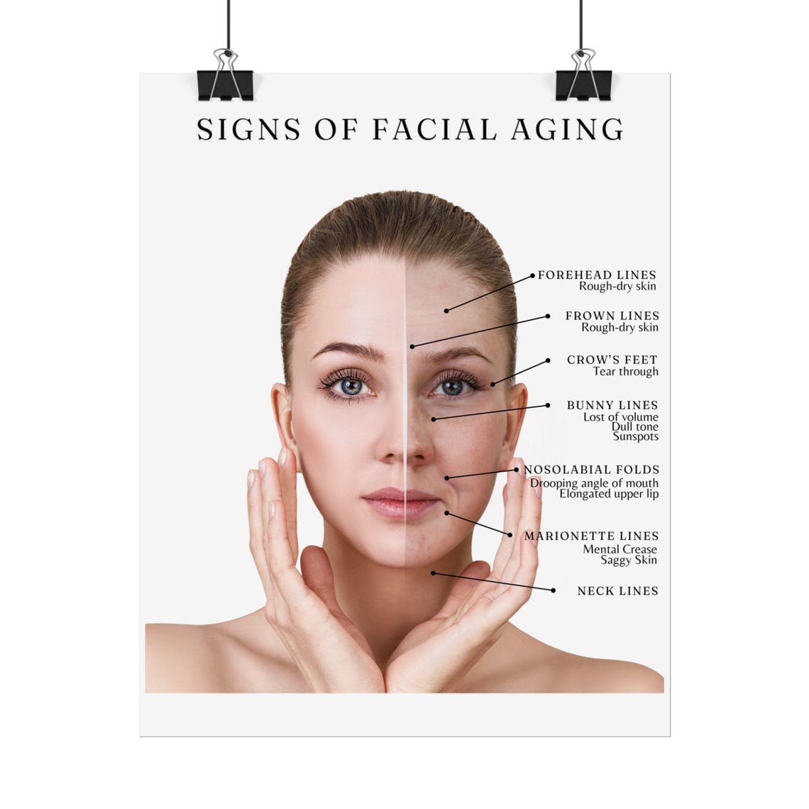 Signs of Facial Aging Rolled Poster, Med Spa Poster, Esthetician Wall ...