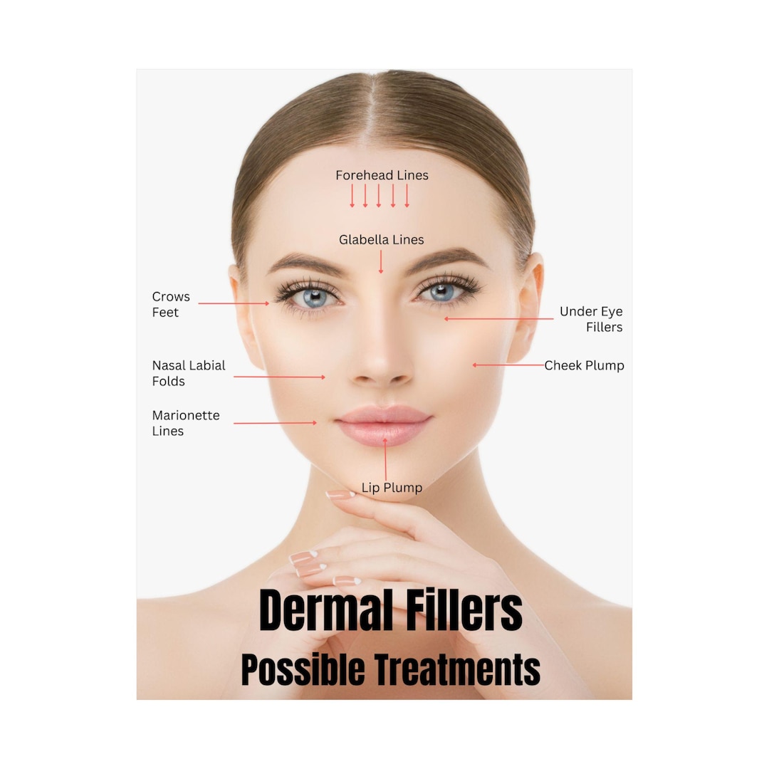 Dermal Filler Possible Treatments Poster, Medspa Nurse Injector Decor ...